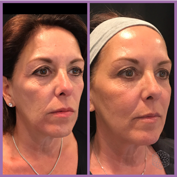 Liquid Face Lift | Clarity Medical Aesthetics
