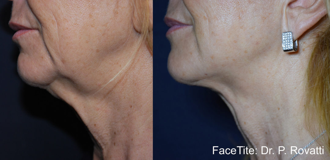 Facetite - Clarity Medical Aesthetics