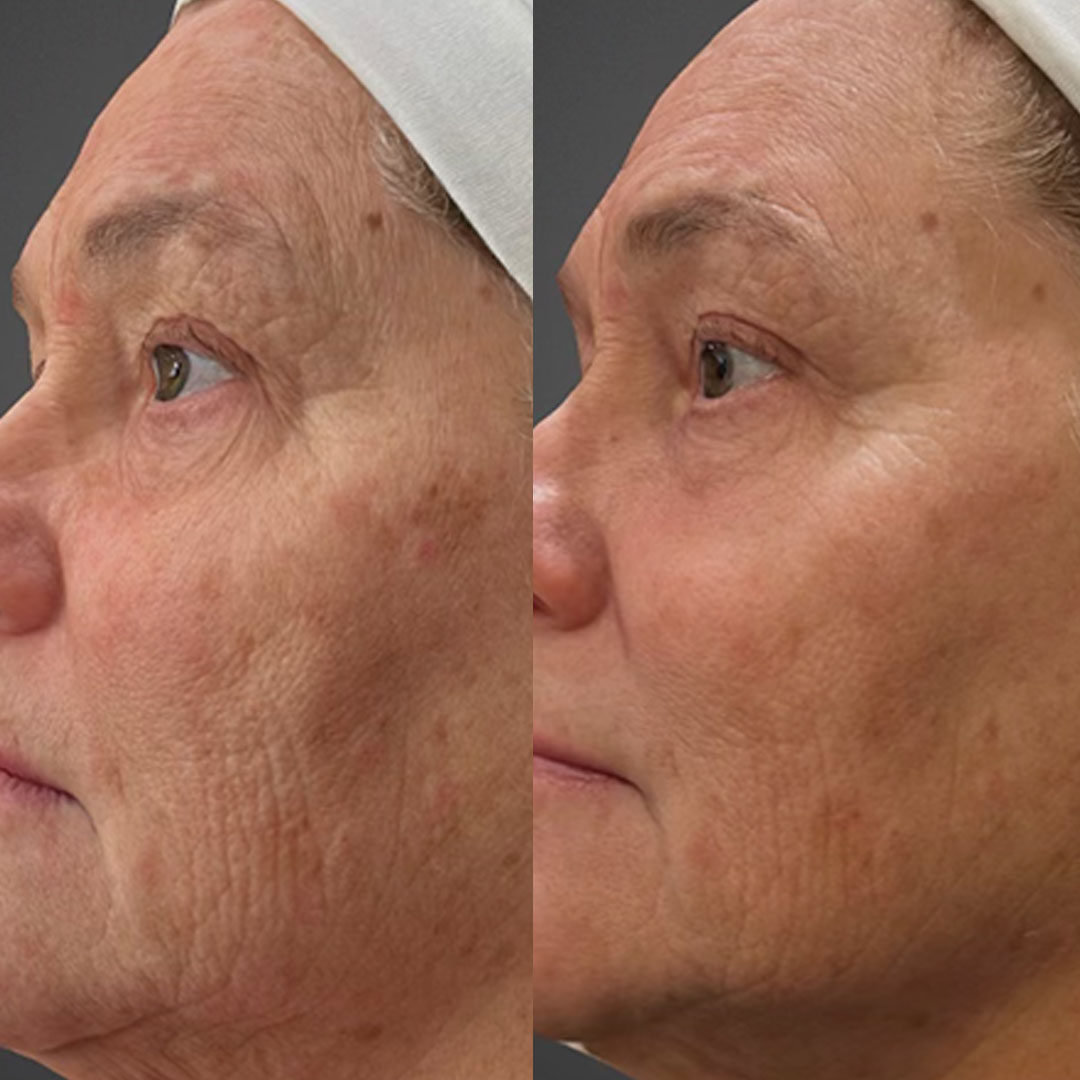 Moxi Laser Treatment Clarity Medical Aesthetics Moxi Laser Treatment Clarity Medical Aesthetics