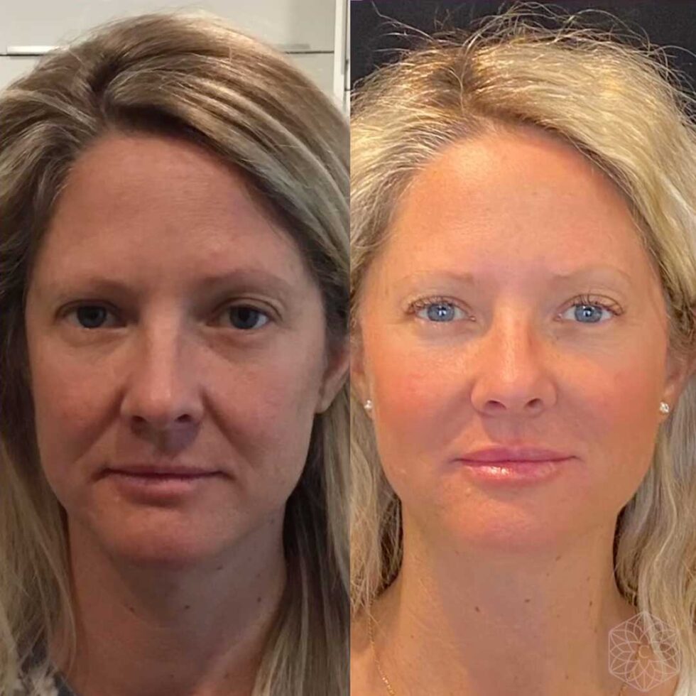 Fillers - Clarity Medical Aesthetics