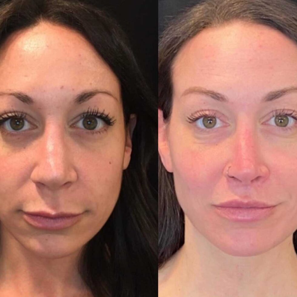 Fillers - Clarity Medical Aesthetics