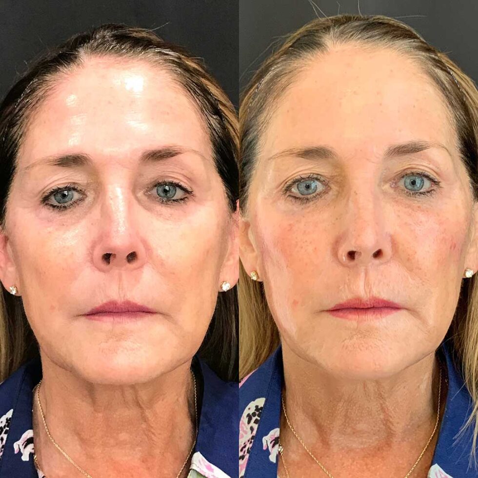 Plasma Gel with PRF - Clarity Medical Aesthetics